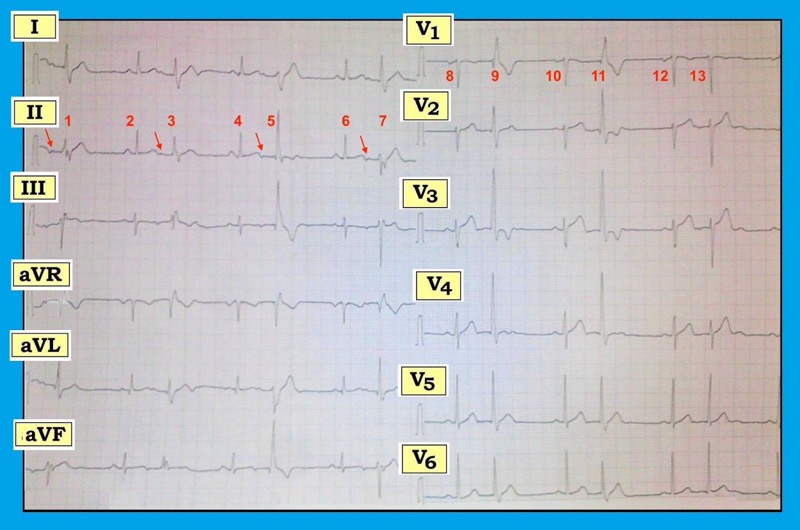 ECG Interpretation: ECG Blog #140 – (PVC – Atrial Bigeminy – PAC – LAHB ...