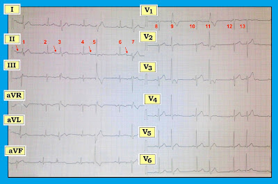 ECG Interpretation: ECG Blog #140 – (PVC – Atrial Bigeminy – PAC – LAHB ...