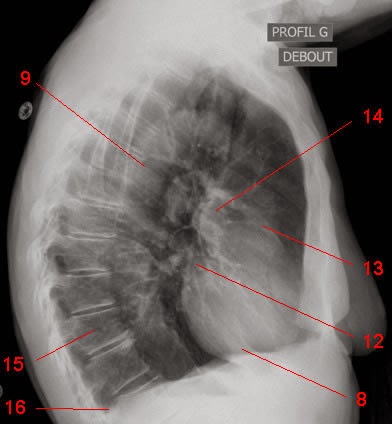 Radiographie du thorax (anatomie) | Culture Médicale