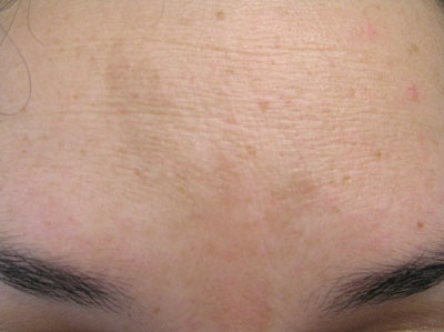 My Health Care: Chloasma (Melasma)