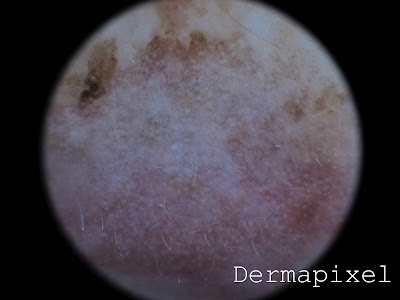 Dermapixel: agosto 2012