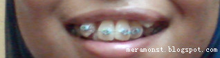 monsterz: Braces #2 : Pasang braces a.k.a gigi besi