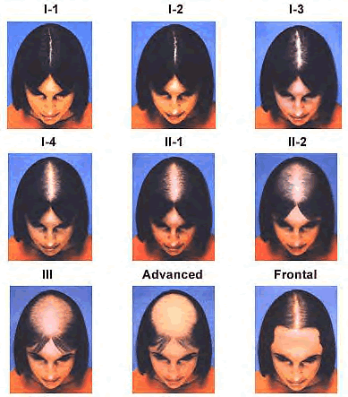 Pattern Baldness In Male / Female | KEY OF BALDNESS