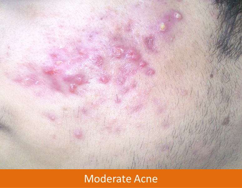 November 2014 ~ Acne Slayer