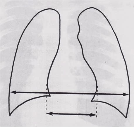 Cara membaca Foto Rontgen Thorak (Chest X-Ray) Dewasa - dokter-medis