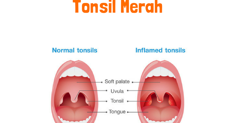 STOKIS QASEHGOLD: Tanda-tanda Bengkak Tonsil
