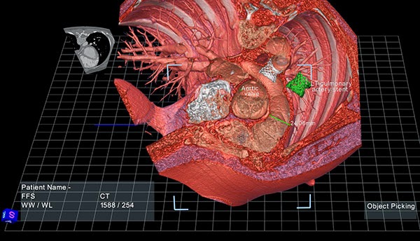 Enfoque Radiologico: Echopixel True3D Visor Pone datos del paciente en ...