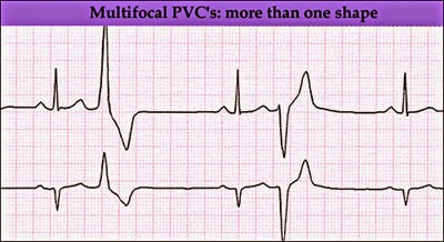Premature Ventricular Contraction / Ventrikular Ekstrasistol | INA - ECG