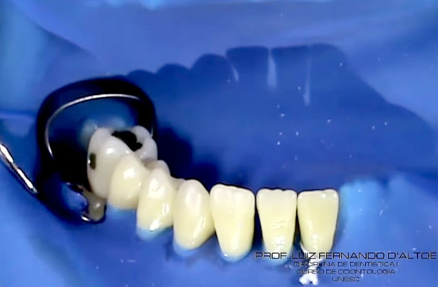 DENTÍSTICA: Isolamento Absoluto - Prof. Luiz Fernando D'Altoé