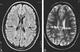 Medical Treatment Pictures-for Better Understanding: Krabbe Disease