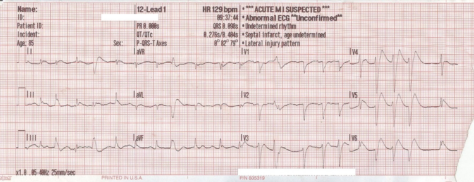 My Variables Only Have 6 Letters: J-waves after ROSC and Intra-arrest ...