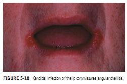 Burket’s Oral Medicine: ACUTE ATROPHIC CANDIDIASIS