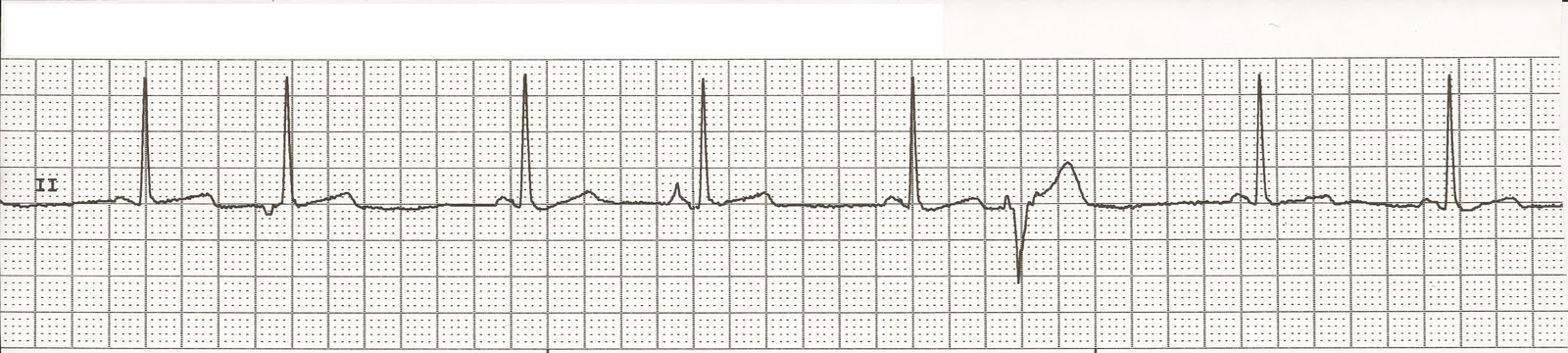 EKG Rhythm Strips 24: Ectopic beats