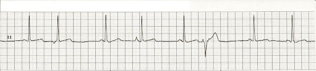 EKG Rhythm Strips 24: Ectopic beats