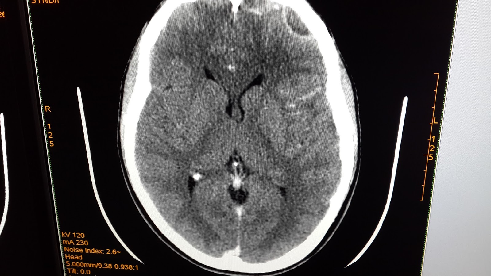 EL RINCON DEL INTERNISTA: Mucocele frontal y absceso epidural ...