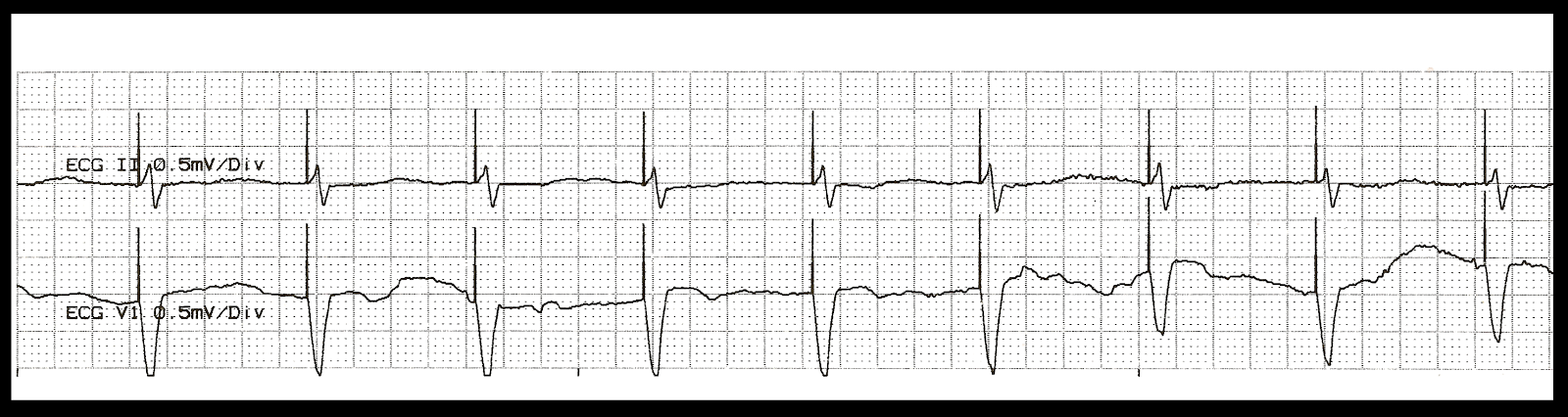 Various Ventricular Paced Rhythms