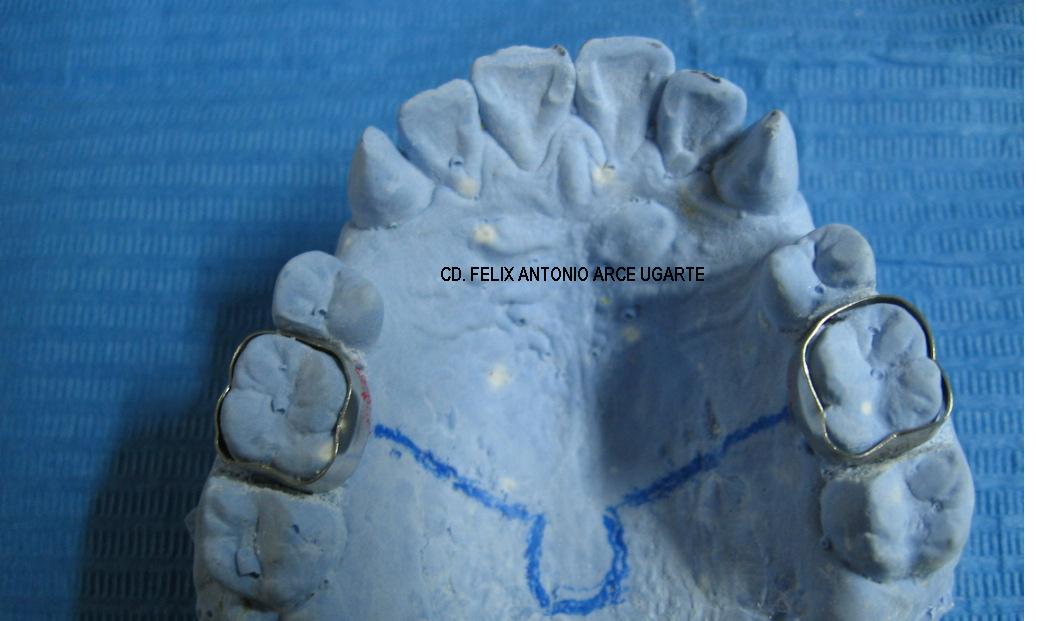 ODONTO-ESTOMATOLOGICA: CONFECCIÓN DE ARCO TRANSPALATINO