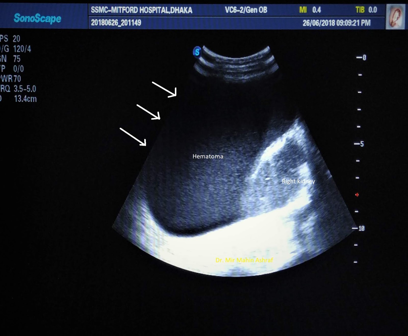 Case 07: Retroperitoneal Hematoma Ultrasound ~ Imaging Study