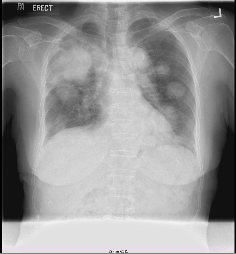 Journey of A Medie: On the Cannonball Lesions