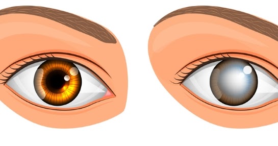 DISSOLVE CATARACTS AND RESTORE PERFECT VISION WITH CASTOR OIL! - HEALTH ...