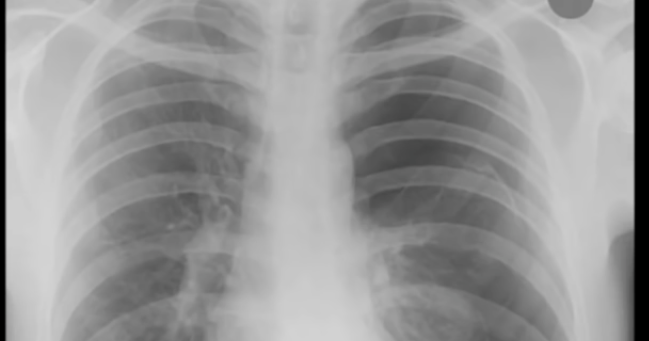 EM Didactic: Deep Sulcus Sign - Pneumothorax
