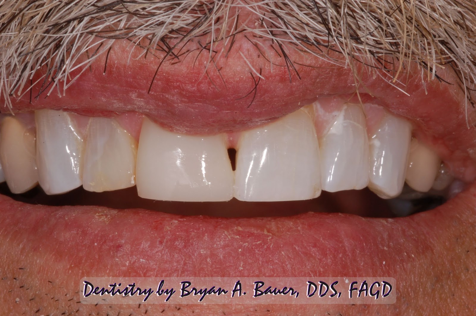A single Composite veneer can make a difference! - Bauer Smiles