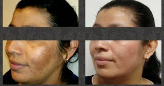 Como Tener Un Rostro Sin Manchas | Como Sacar Manchas De La Piel