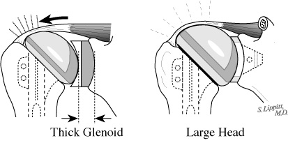 UW Shoulder and Elbow Academy: Revision surgery for stiff total ...