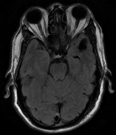 Dr Balaji Anvekar FRCR: Neuroglial cyst MRI