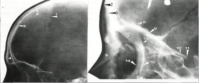 Dentistry lectures for MFDS/MJDF/NBDE/ORE: Note on Radiographic Anatomy ...