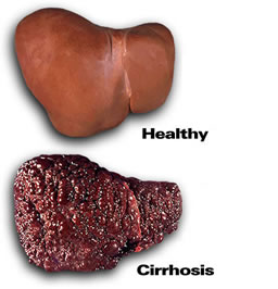 Penanganan Sirosis Hepatis