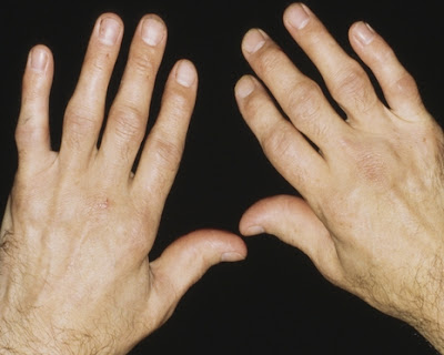 Health and Safety: Arthritis : Causes and Home Remedies for Arthritis