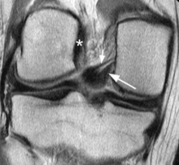 Radiology Channel: Anatomy of bundles of ACL and PCL.