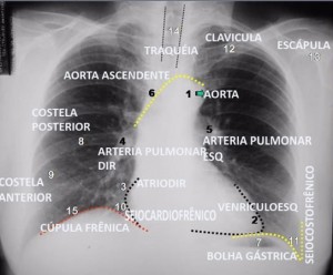 Viver Enfermagem em Cuidados Intensivos: RX TORAX NORMAL E PNEUMONIA ...