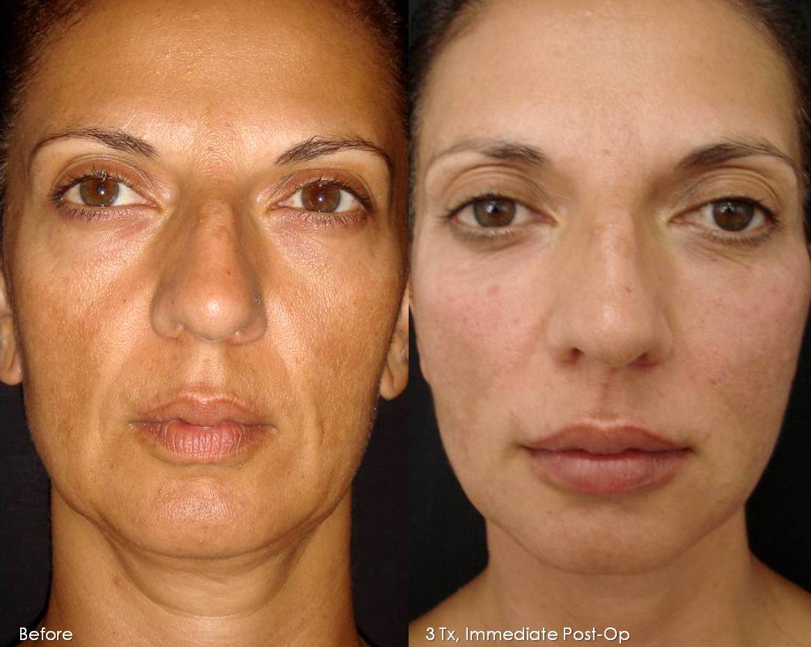 DermaSphere: Is PRP The Proverbial Elixir Of Youth?