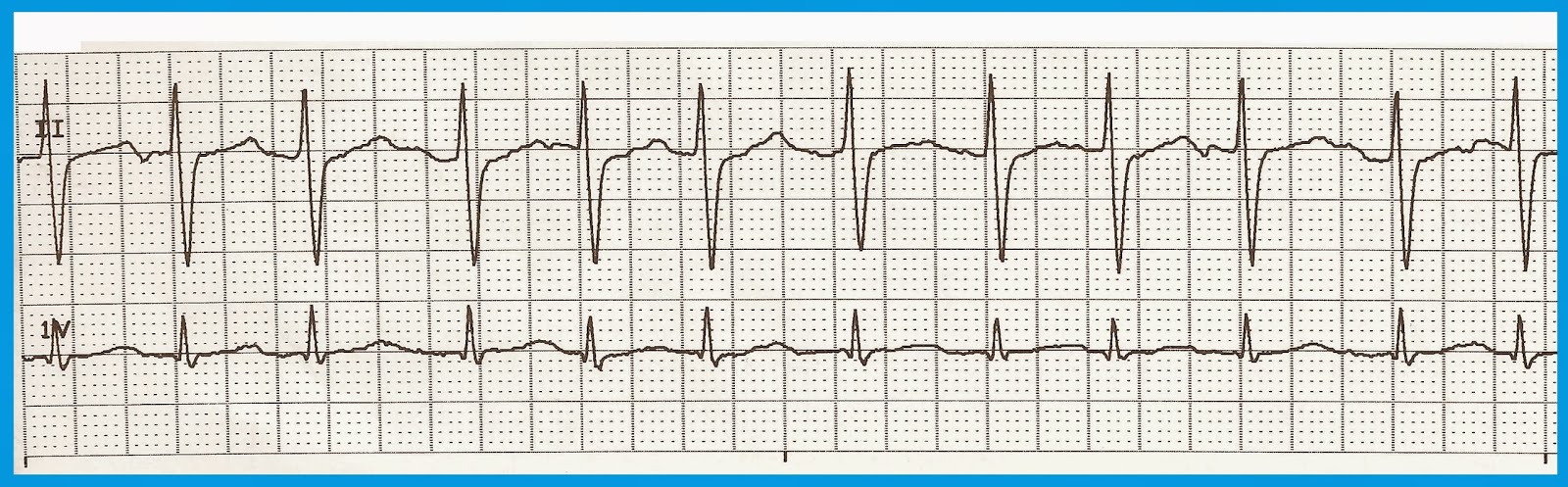 Practice EKG Rhythm Strips 232
