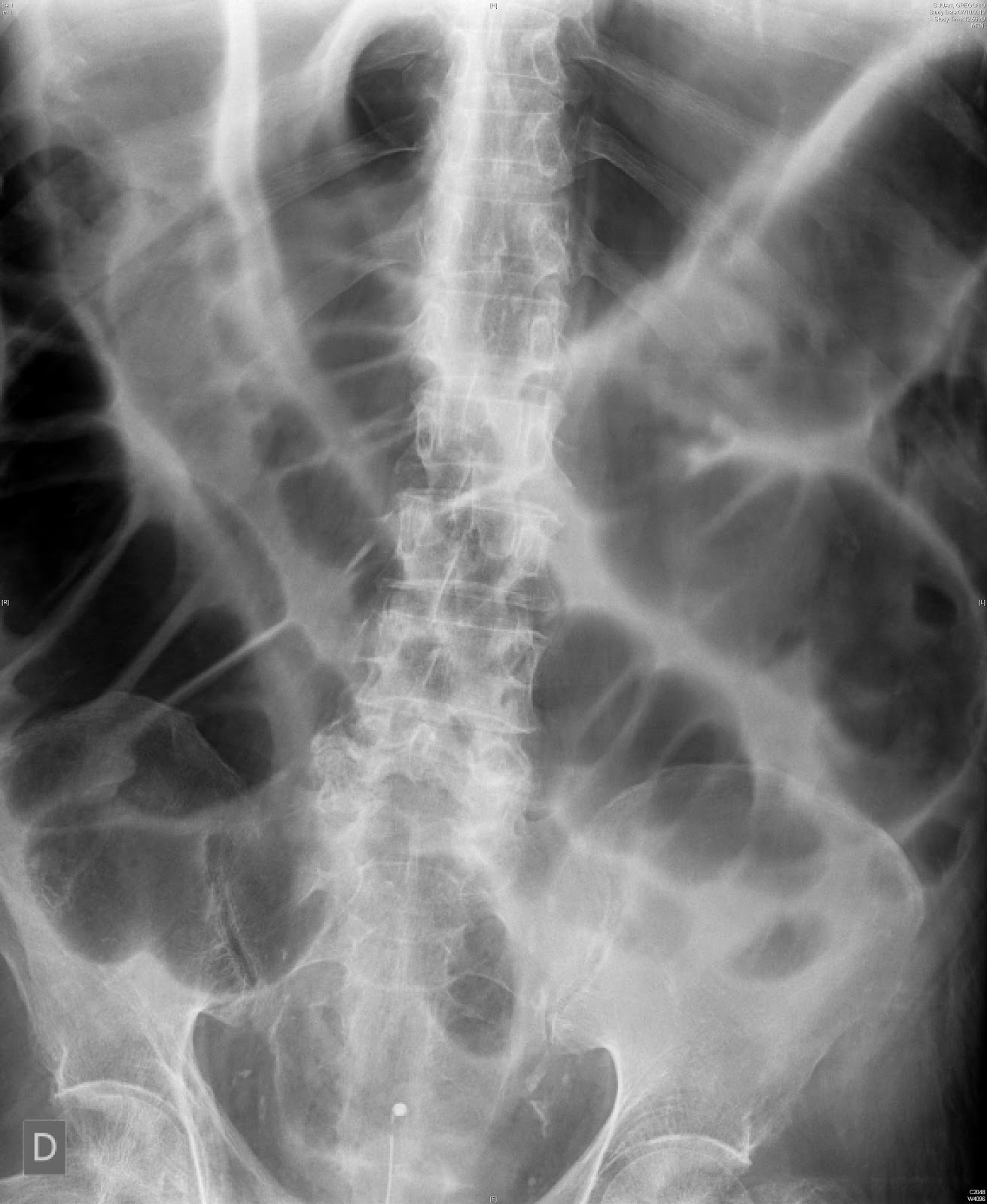 Docencia Alto Palancia: Sindrome de Ogilvie