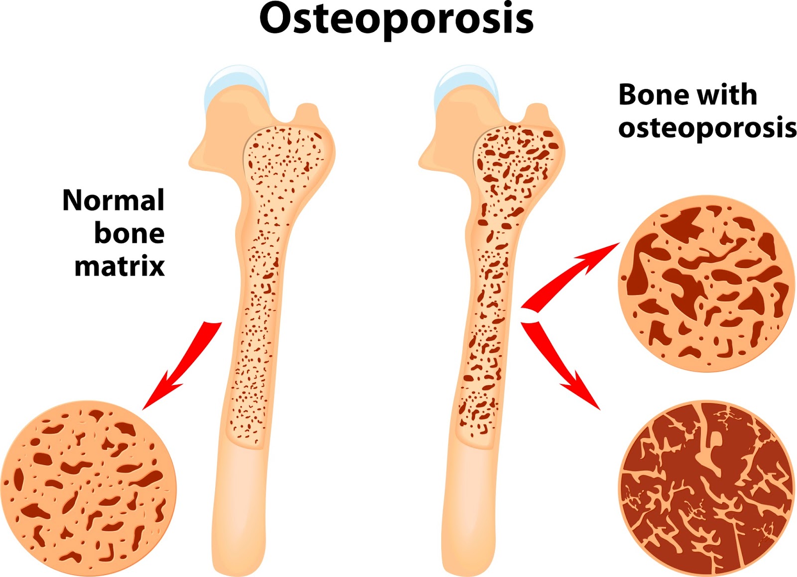 Osteoporosis and Bone Density Drugs May Be a Problem - Health Care Center