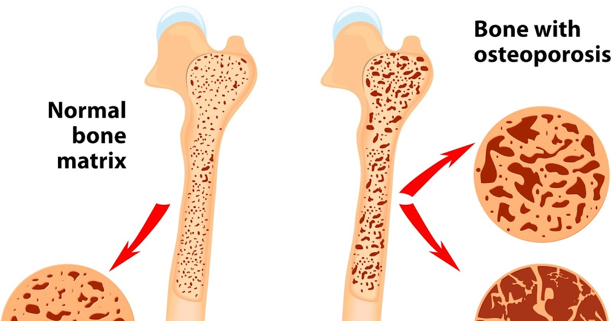 Osteoporosis and Bone Density Drugs May Be a Problem - Health Care Center