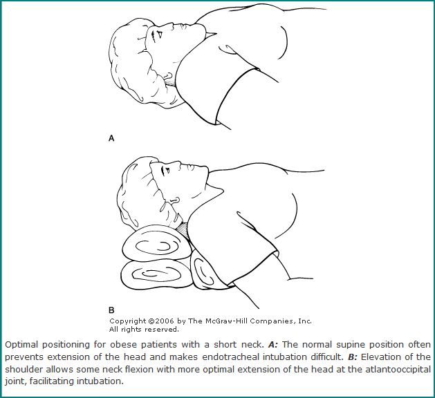 What is the optimal position to intubate an obese patient? | little ...