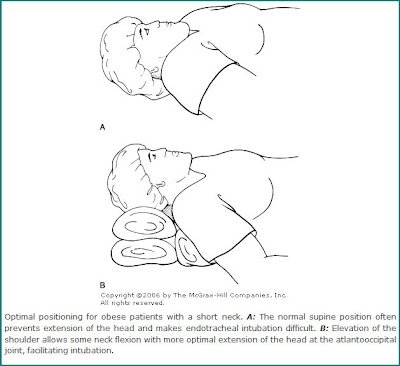 What is the optimal position to intubate an obese patient? | little ...