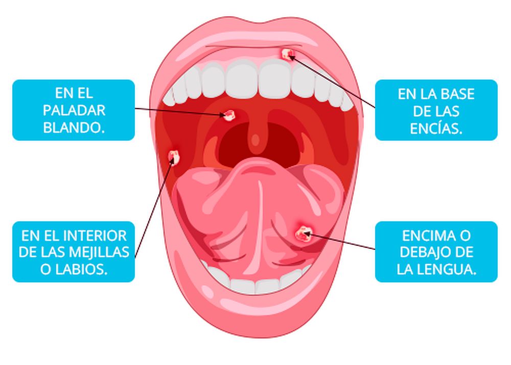 Esto es lo que dice las aftas bucales de tu salud | Directorio Odontológico