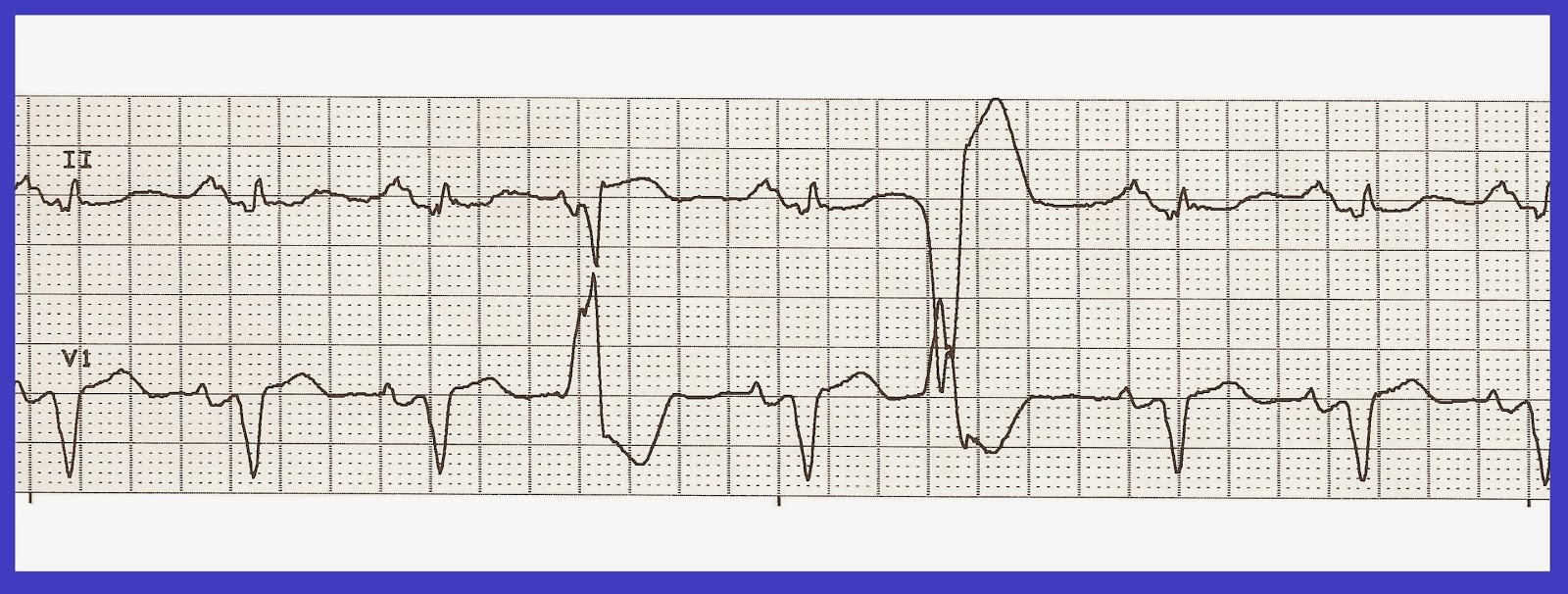 EKG Rhythm Quiz 235