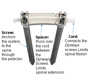 van Rugpijn naar een Fijne rug: Dynesys