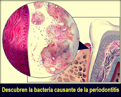 NI1060: Esta es la bacteria causante de la Periodontitis