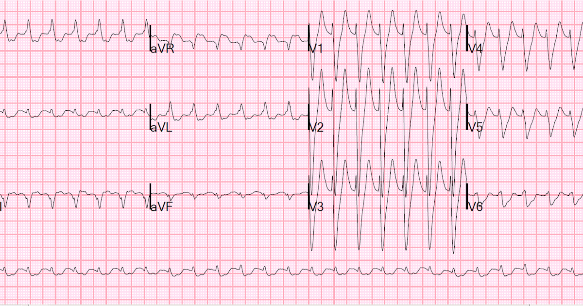 Dr. Smith's ECG Blog: Several Wide Complex Rhythms in One Patient. Test ...