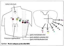 materi p3k: cara pemasangan EKG
