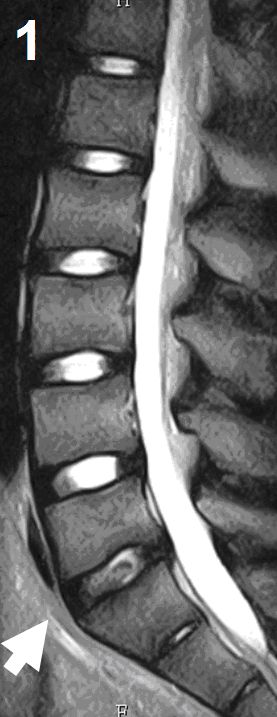 Spine Update 脊椎新事: Pathophysiology and Management of Degenerative Disk ...
