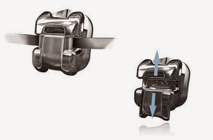 Estudos Odontológicos: Eficiência do tratamento com braquetes ...