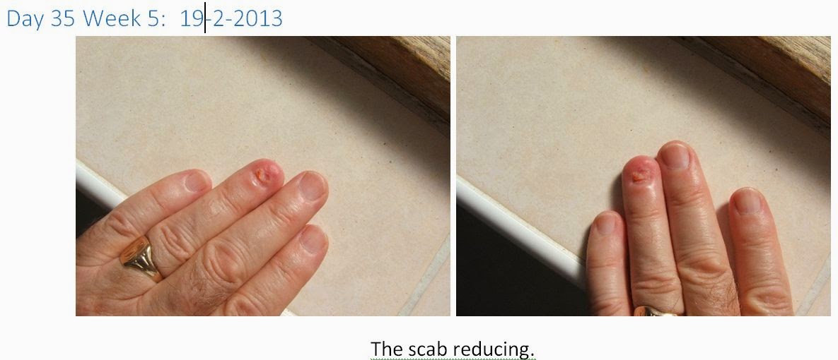 Personal Touch Works: Recovery from a ripped off finger nail